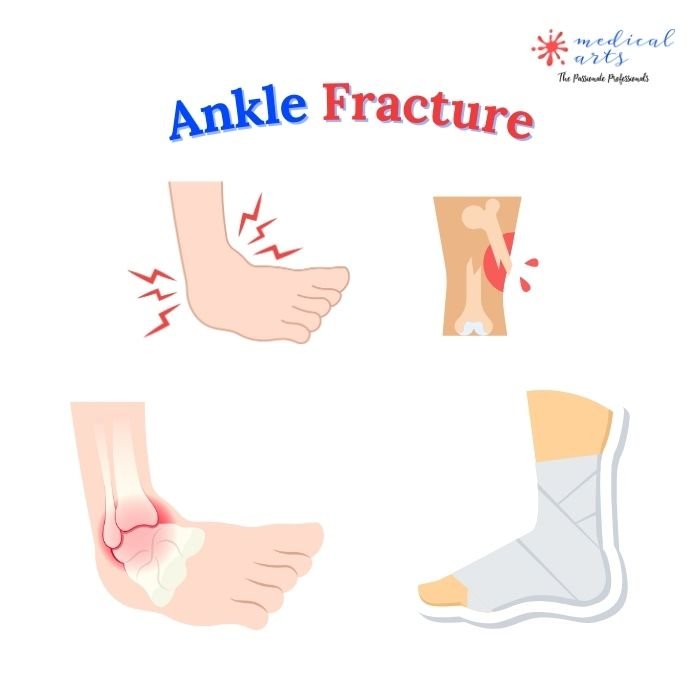 Ankle Fracture: An In-Depth Look at Treatment – Medical Arts Shop