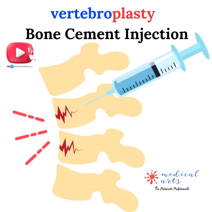Bone Cement Injection: Vertebroplasty Explained – Medical Arts Shop