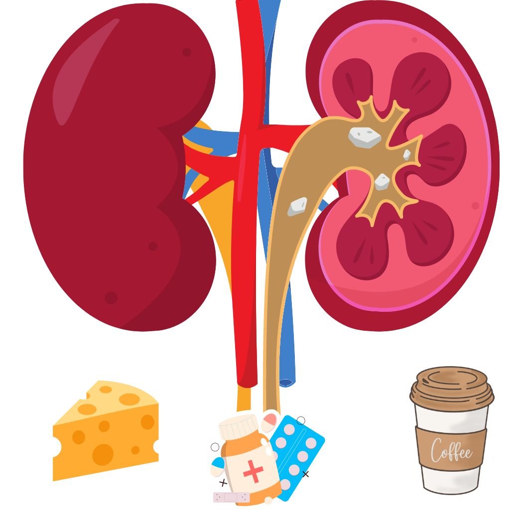 How to prevent KIDNEY STONES – Medical Arts Shop