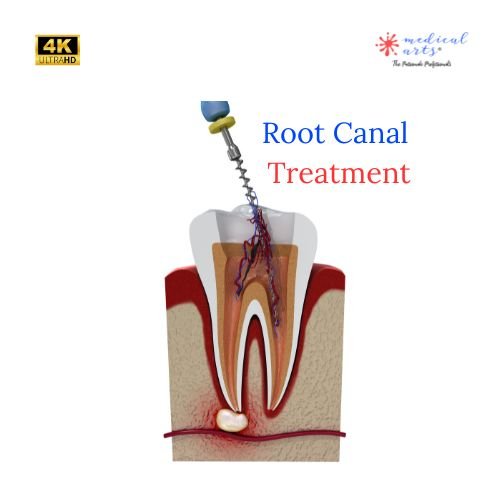 Process of Root Canal Treatment - Video – Medical Arts Shop