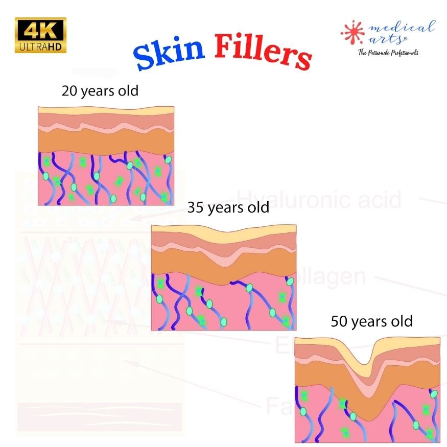 Skin Fillers & Wrinkle Treatments Guide – Medical Arts Shop